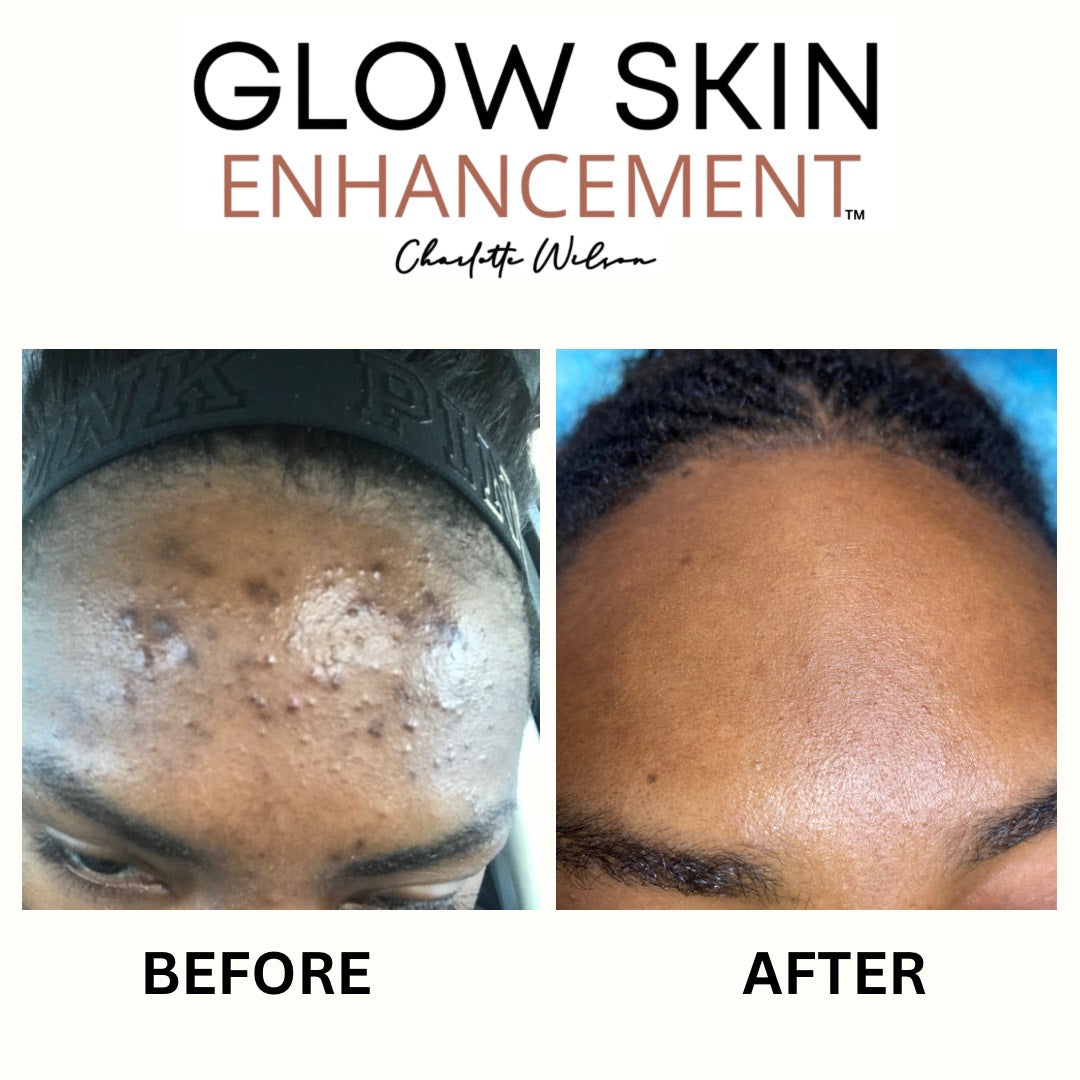 6 Piece Acne Kit-hers– Glow Skin Enhancement