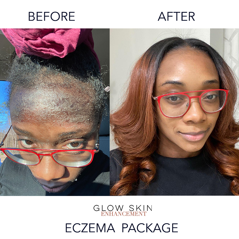 ECZEMA RELIEF PACKAGE (Real Results)– Glow Skin Enhancement
